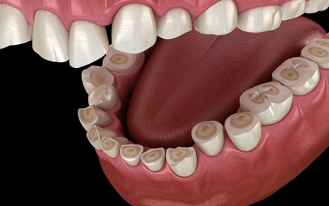 Teeth Grinding | The Dental And Denture Care Center | Spring Hill, Florida