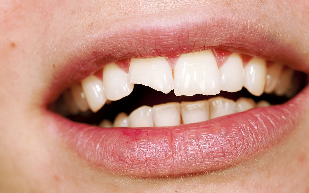 Chipped Tooth Repair | The Dental and Denture Care Center | Spring Hill